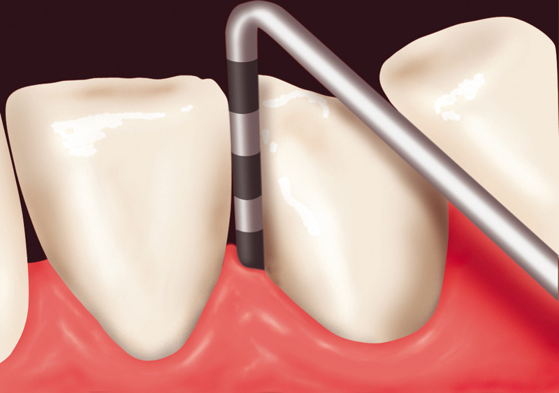 Parodontose Zahnfleisch Taschentiefe Frühuntersuchung Vorsorge